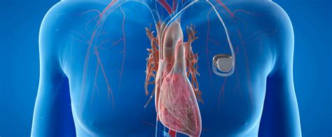 Aicd Automatic Implantable Cardioverter Defibrillator