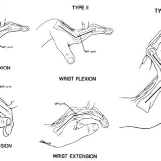 Classification Of Contracture On MCP Joint Download Scientific Diagram