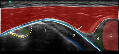 Shoulder Subscapularis Tendon 2 Image Sonosite Institute For Point Of Care Ultrasound