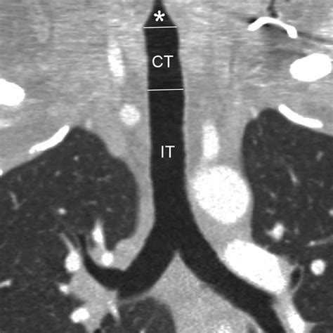 Anatomy Of The Larynx And Cervical Trachea Neuroimaging Clinics