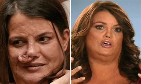 The Most Shocking Botched Plastic Surgery Transformations Life And Style