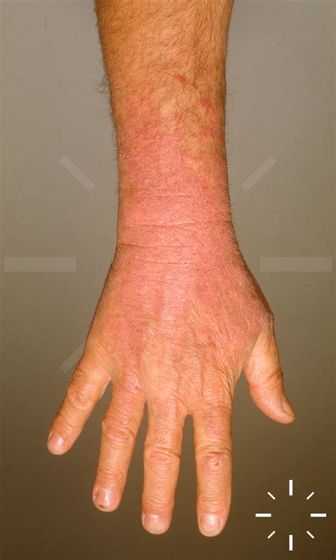 Polymorphous Light Eruption Lupus