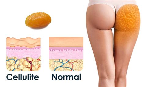 Cellulite Treatment Infinium Clinic Gatineau Ottawa