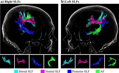 Dti Tractography Of The Slf An Illustrative Case Of Dti Tractography