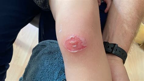 Fallbeispiel Schürfwunde Am Knie Heilungsverlauf Fotos