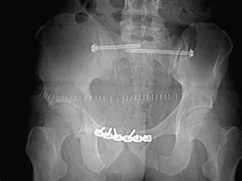 1 Open Book Fracture Open Reduction And Internal Fixation Of A Download Scientific Diagram