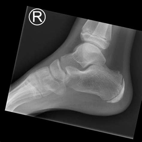 Calcaneum Calcaneal Plating System Acumed