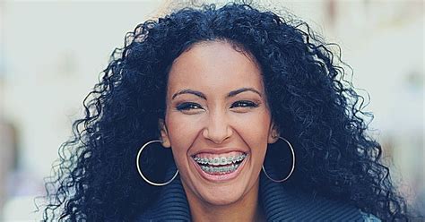 Do Braces Give You A Lisp Ultimate Guide Year