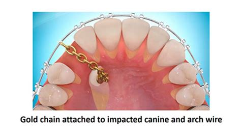 Impacted Canines Hill Country Oral Surgery Austin Tx