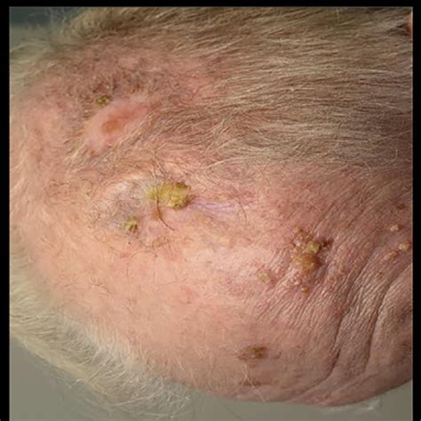 Photograph Of Scalp Pg Lesion Over Time January 2016 Download