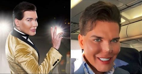 Meet Rodrigo Alves A Plastic Surgery Addict Who Has Been Hospitalised With A Rotting Nose