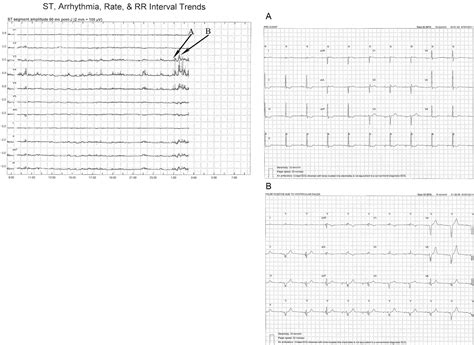 A Research Method For Detecting Transient Myocardial Ischemia In