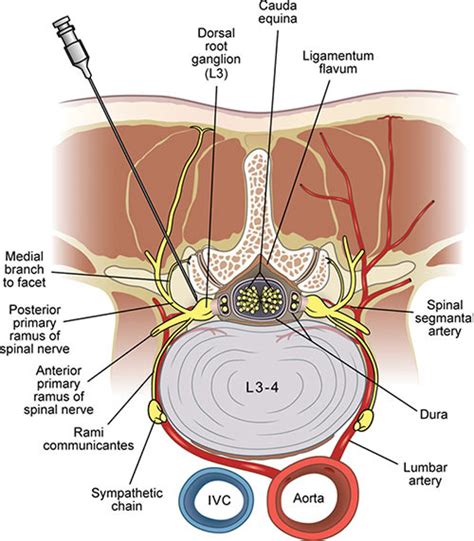Thoracic Epidural Injections In Nyc