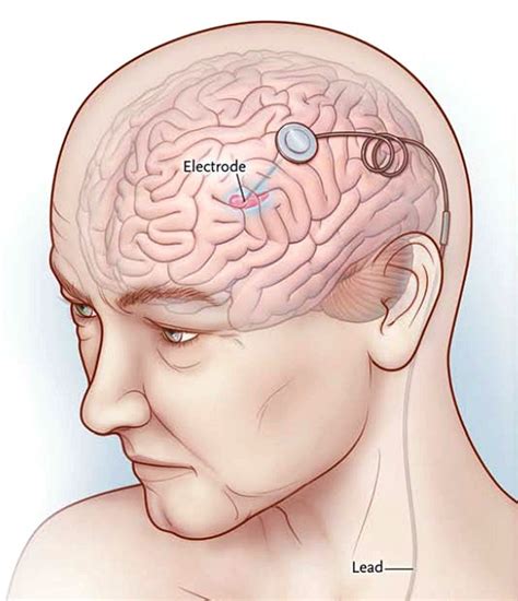 Deep Brain Stimulation Can Be Effective For Severe Depression Medisi