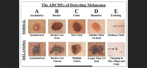 Detecting Melanoma Guide R Medical