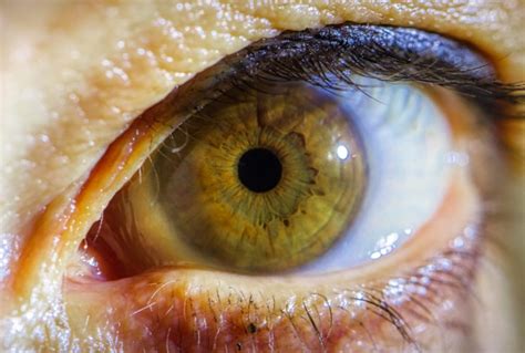 Stadi Della Retinopatia Diabetica Cosa Accade Passo Dopo Passo