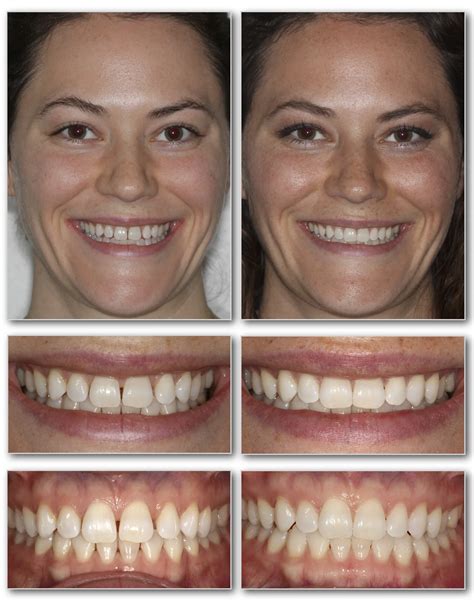 Invisalign Before And After Spacing