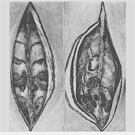 Stages Of A Spinal Fusion With The Cutting Of The Spinous Processes And