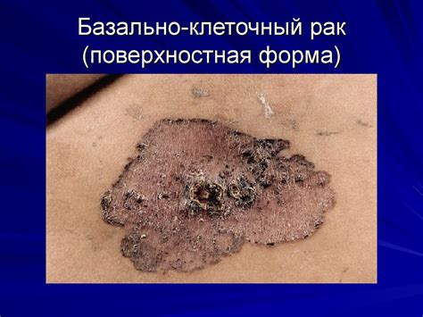 Рак кожи и меланома презентация онлайн