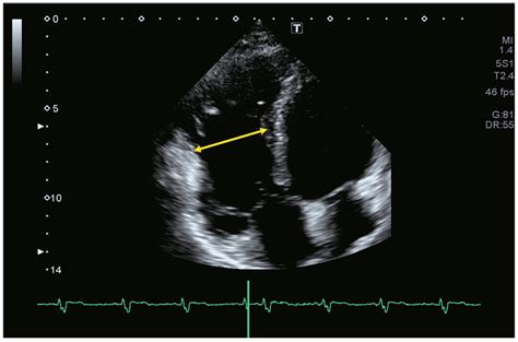 Measurement Of Mid Cavity Right Ventricular Dimension Rv Focused Apical Download Scientific