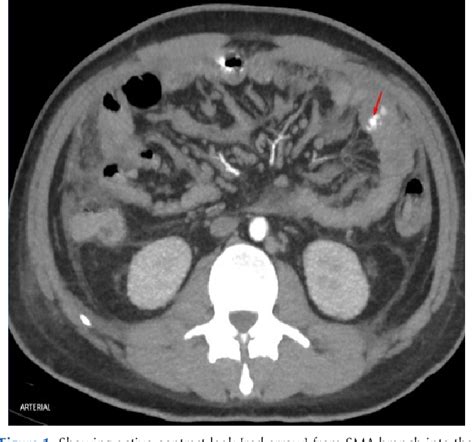 Figure 1 From A Case Of Massive Gastrointestinal Bleeding Due To