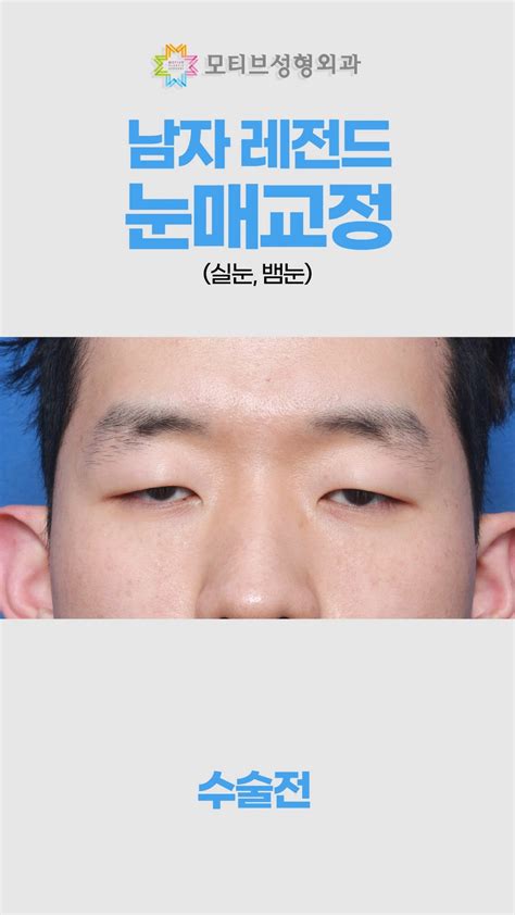모티브 성형외과 제대로 된 남자눈매교정 은 이런 결과입니다 서울대 의대 출신 미적감각이 뛰어난 박재희 원장의 눈성형 눈재수술 중점 진료 병원 압구정