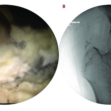 Pelvic Anteroposterior Ap Radiograph Showing Calcification Over The Download Scientific