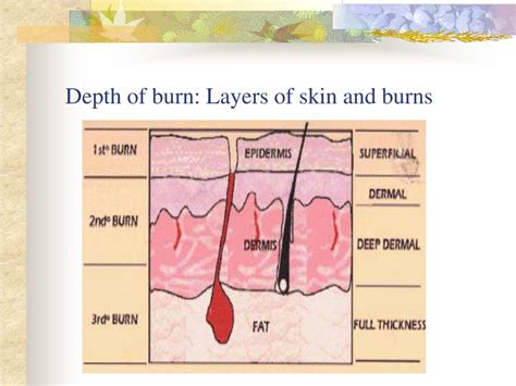 Layers Of Skin Burns At Christy Redfield Blog