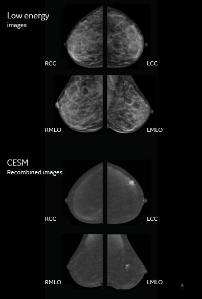 Contrast Enhanced Spectral Mammography Cesm Regional Medical Imaging
