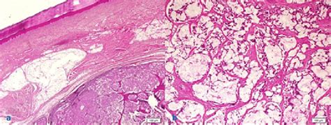 A The Dermal Tumor Had A Cribriform Pattern Hande Â20 B Thin Download Scientific Diagram