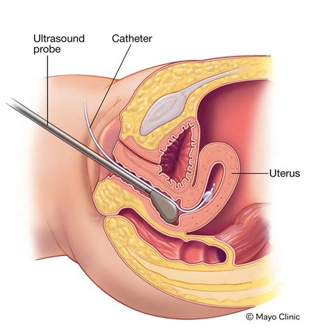 Uterine Polyps Removal Endometrial Polyps Concise Medical Knowledge
