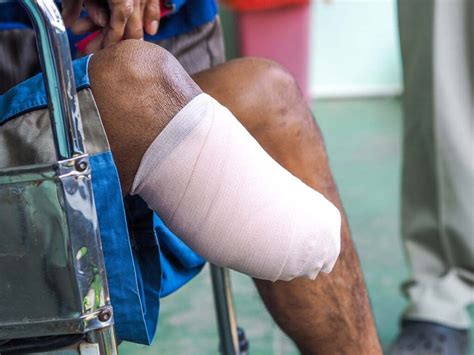 How To Prevent Amputation Of A Diabetic Foot Southern California