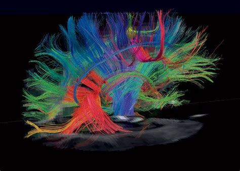 Al Fin Diffusion Tensor Imaging Becoming Super Brain Assessment Tool