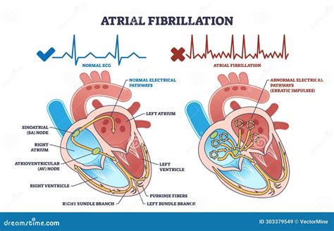 Atrial Fibrillation As Abnormal Heart Beat Frequency Disease Outline Diagram Stock Vector