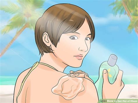 3 Ways To Get Rid Of Hives WikiHow Health 3 Ways To Get Rid Of Hives WikiHow Health