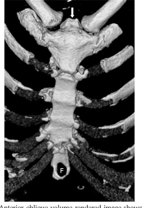 Figure 7 From Multidetector Row Ct Findings Of A Sternal Variation
