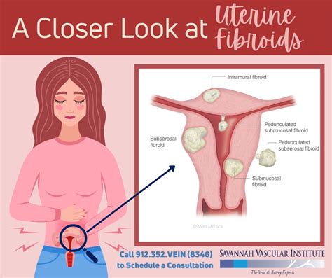 Savannah The Main Types Of Fibroids Are Intramural Fibroids The Most Common Type Of Fibroid