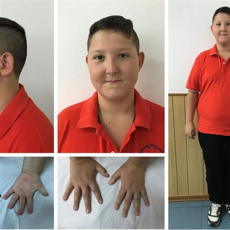 Photographs Of Our Patient Showing Dysmorphic Facial Features In Download Scientific Diagram