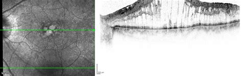 Diabetic Macular Edema Risk Factors And Treatment Options Dr Rehman Siddiqui