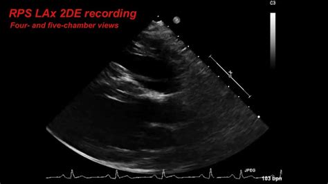 05 10 Pulmonic Stenosis Youtube