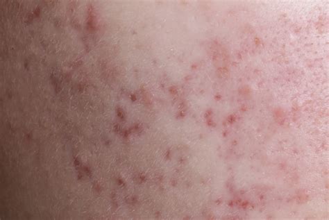 Skin Concerns Scarring D Thomas Clinic