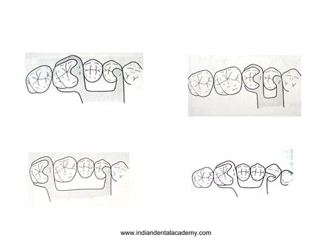 Mandibular Class I Situationendodontic Courses Ppt