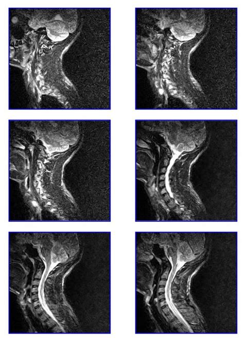 Nerve Or Spine Compression R Spinesurgery