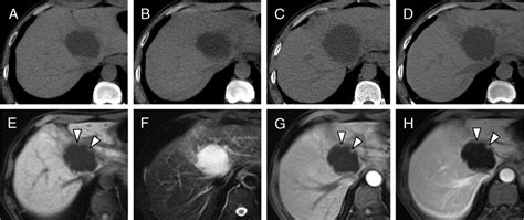 A Case Of Cystic Intrahepatic Cholangiocarcinoma Mimicking A Clinical Nuclear Medicine