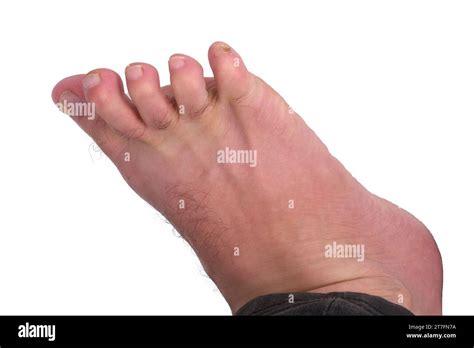 Nail Fungus Infection On Big Toe Fungal Infection On Fingernails Toe