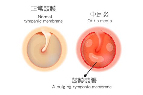 中耳炎