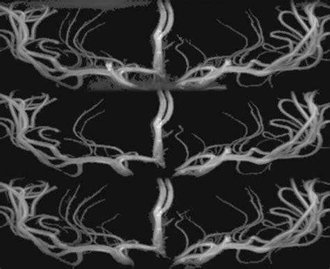 Median Filtered Segmentations Median Filter Subtraction Segmentations Download Scientific