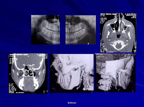 Common Syndromes Affecting The Head And Neck Ppt