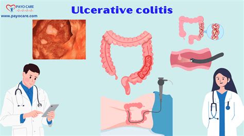 Ulcerative Colitis Causes Symptoms And Treatment 110min