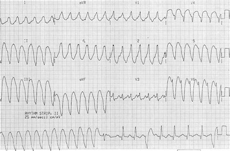 Aritmia Workshop Ekg Dokter Alfa Belajar Kedokteran